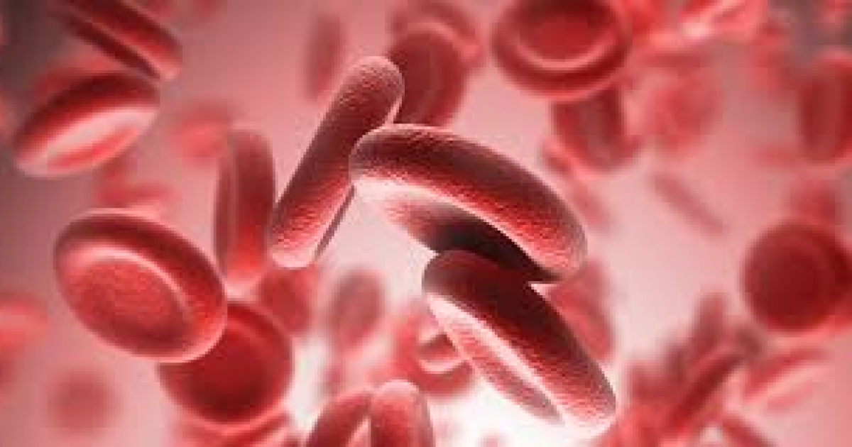 Sicklemia o drepanocitosis